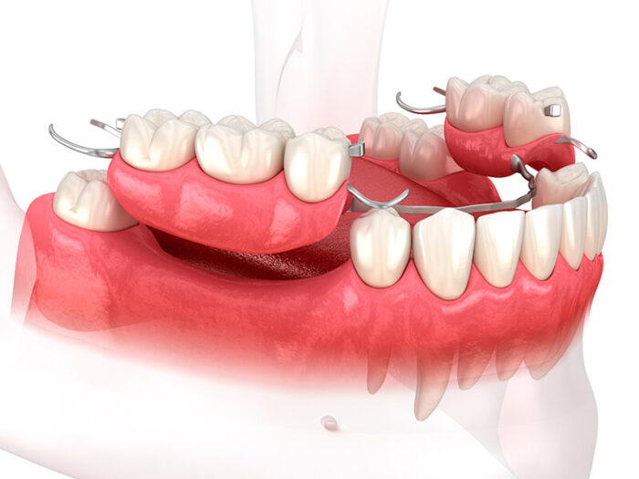 Próteses dentárias na Vila Matilde em São Paulo - SP - Arte Ortho